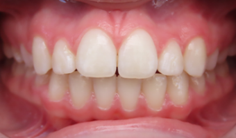 Braces & Invisalign Before & After Results | Lakeside Orthodontics